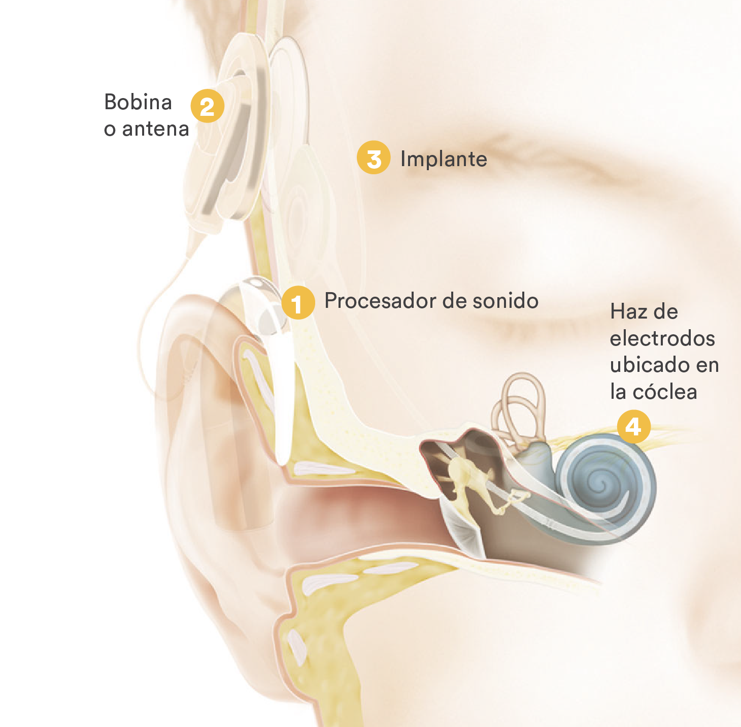 ¿El procesador de implante coclear de sonido es discreto?
