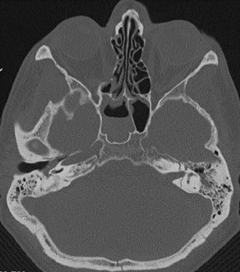 Novedades en implantes cocleares. Estudio de caso. Cochlear