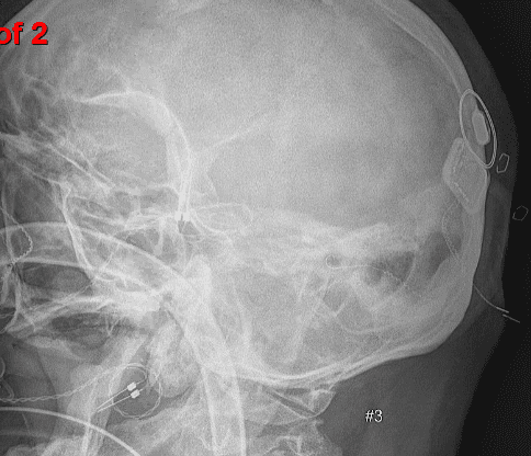 Novedades en implantes cocleares. Estudio de caso. Cochlear