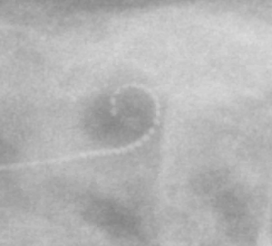 Caso de Estudio: Corrección intraoperatoria de una colocación de CI632 ...