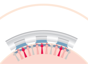 Electrodo Cochlear™ Slim Modiolar Un electrodo diseñado para adaptarse ...