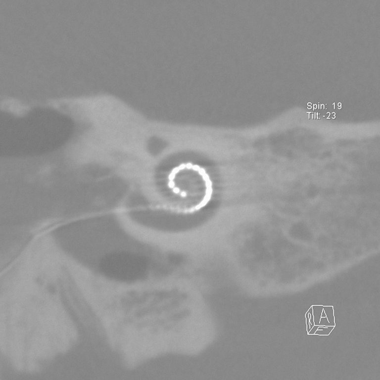 Electrodo Cochlear™ Slim Modiolar Un electrodo diseñado para adaptarse ...