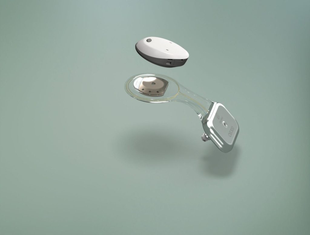 Todo lo que necesitas saber sobre la cirugía para la implantación del ...